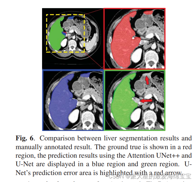 9.论文学习Attention Unet++: A Nested Attention-Aware U-Net for Liver CT Image Segmentation_unet++的激活 ...