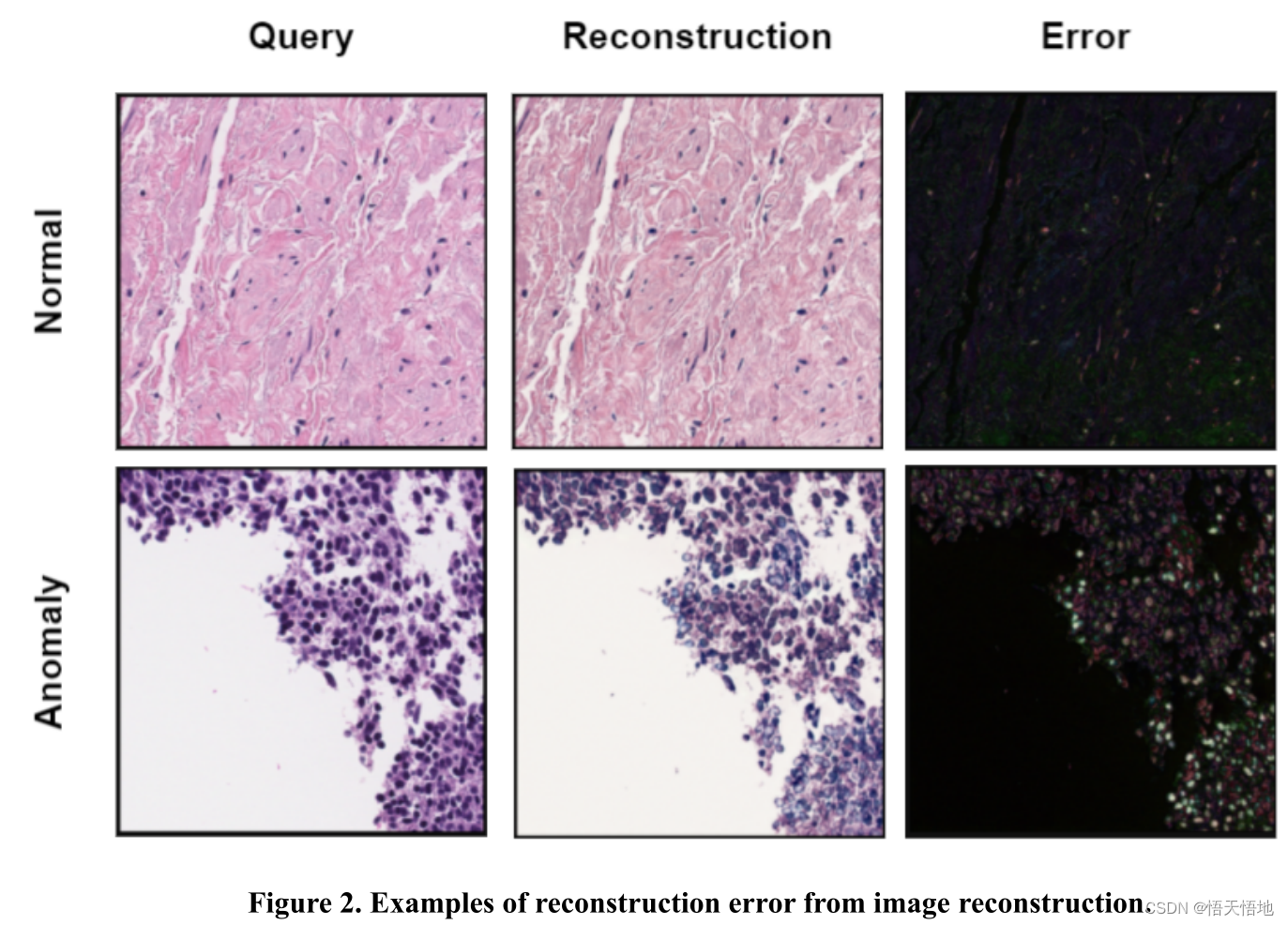 论文笔记——Using Progressive Context Encoders for Anomaly Detection in Digital Pathology Images_slide ...