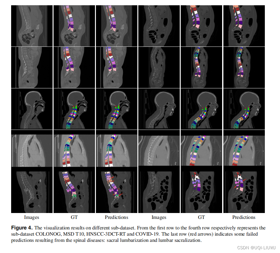 论文笔记：CTSpine1K: A Large-Scale Dataset for Spinal Vertebrae Segmentation ...