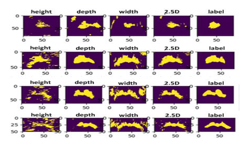 A 2.5D Cancer Segmentation for MRI Images Based on U-Net_2.5d分割 深度学习-CSDN博客