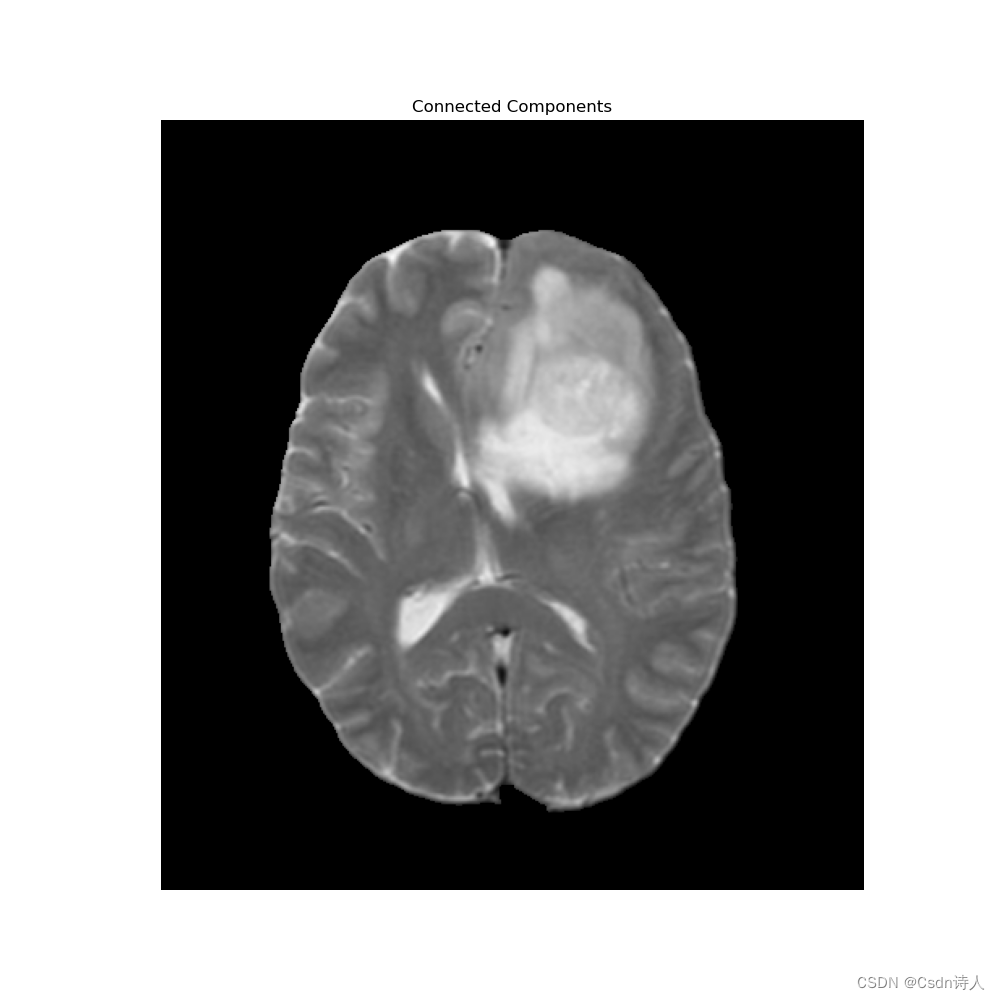 头骨剥离MRI_用python语言实现去除脑部mri图像中的头骨-CSDN博客