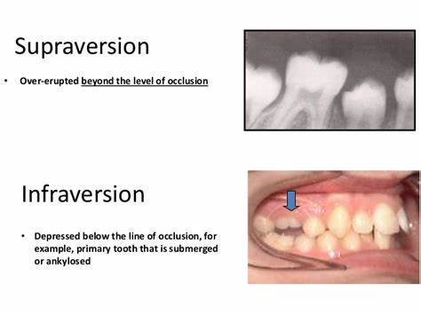 infraversion和superaversion-CSDN博客