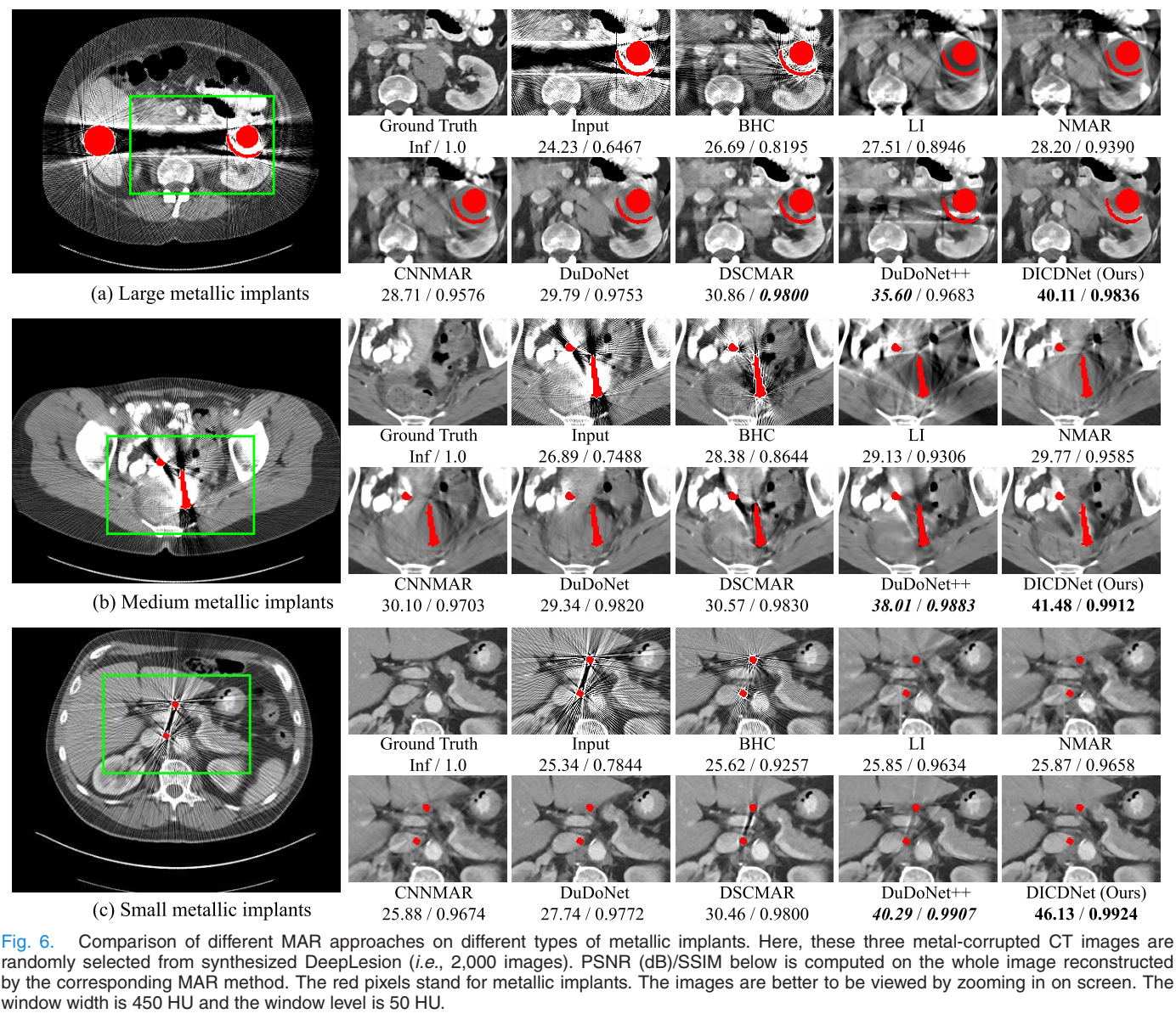 Deep Interpretable Convolutional Dictionary Network For Metal Artifact Reduction In Ct Images 卷积