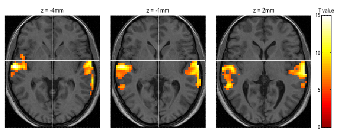 利用matlab的SPM12功能核磁共振成像数据处理_Auditory fMRI data（三）_核磁spmt-CSDN博客