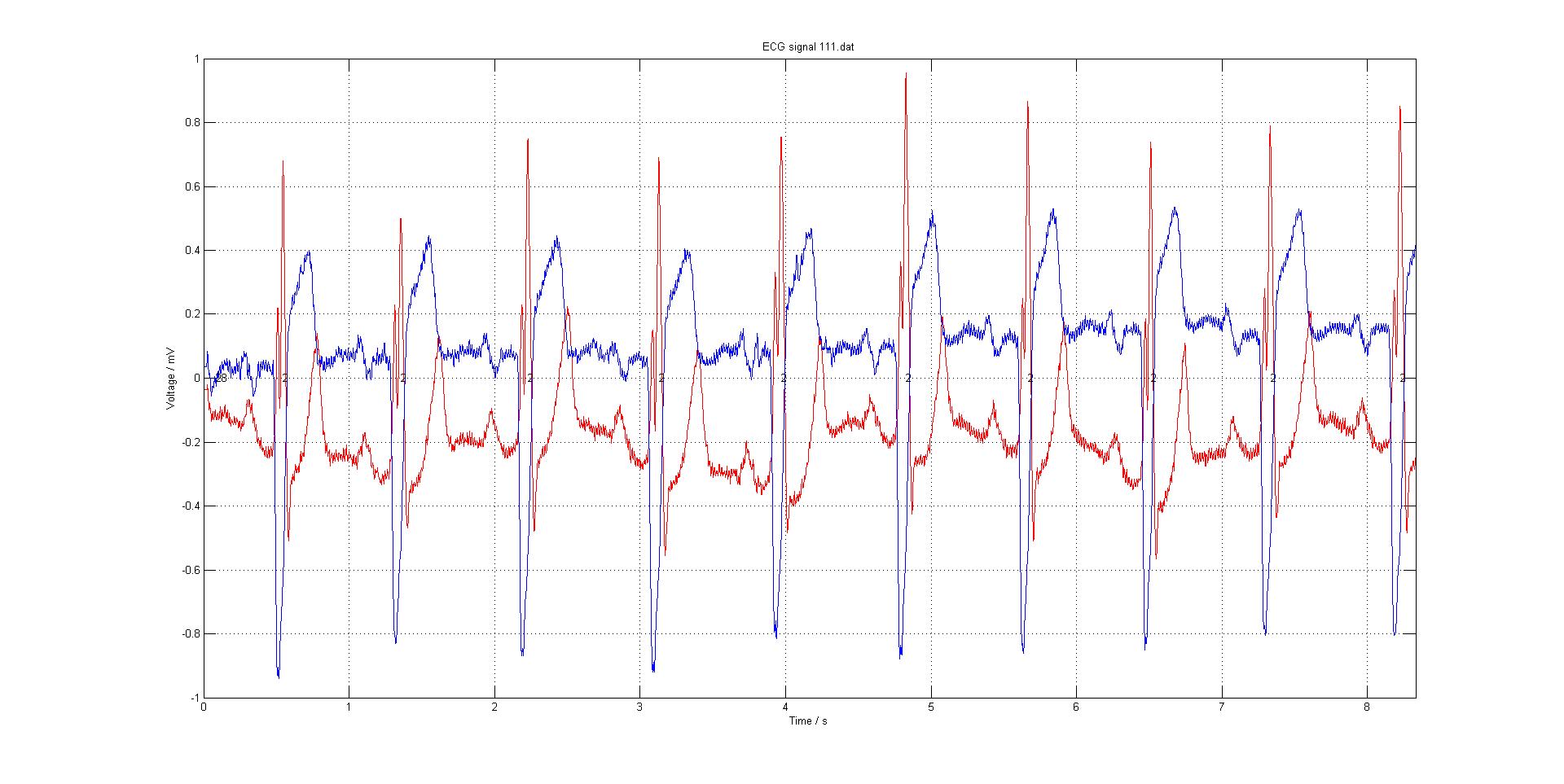 ECG信号读出，检测QRS，P，T 波（小波去噪，并根据检测），基于BP辨识的神经网络-CSDN博客