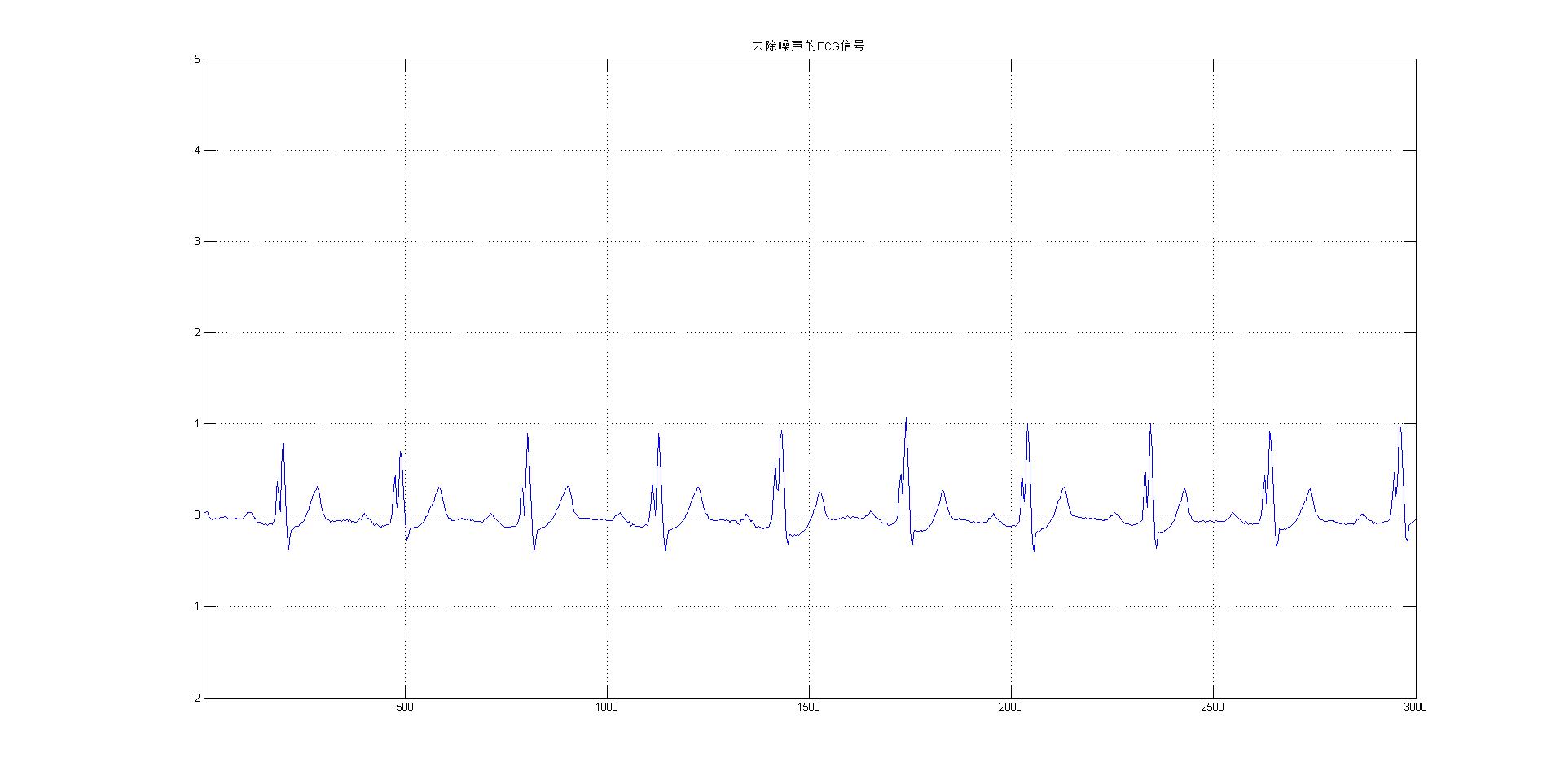 ECG信号读出，检测QRS，P，T 波（小波去噪，并根据检测），基于BP辨识的神经网络-CSDN博客