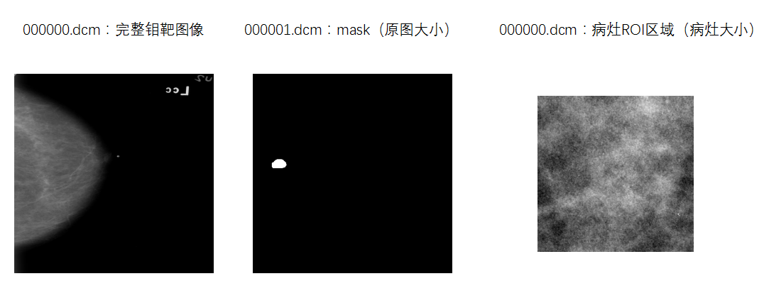 深度学习：乳腺x检测_cbis-ddsm数据集-CSDN博客