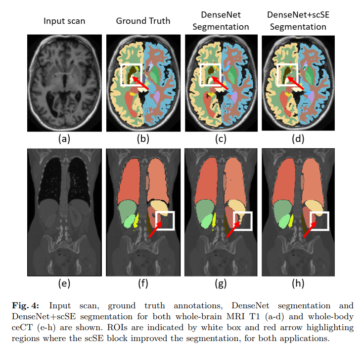 Spatial-Channel Sequeeze & Excitation (SCSE)-8-June-2018【论文理解】_se spatial and channel-CSDN博客