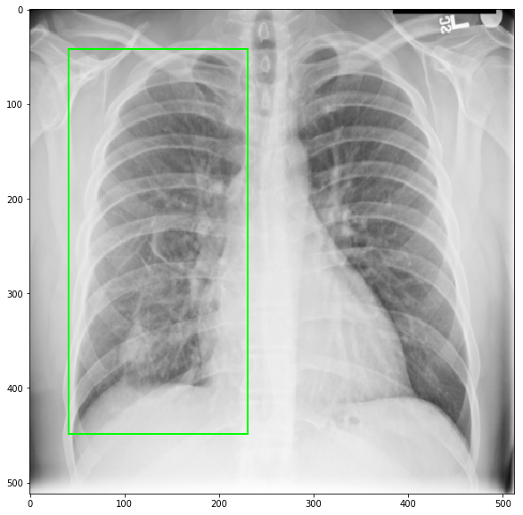 在 chest X-ray 数据集上做肺分割_chexpert-v1.0.zip-CSDN博客