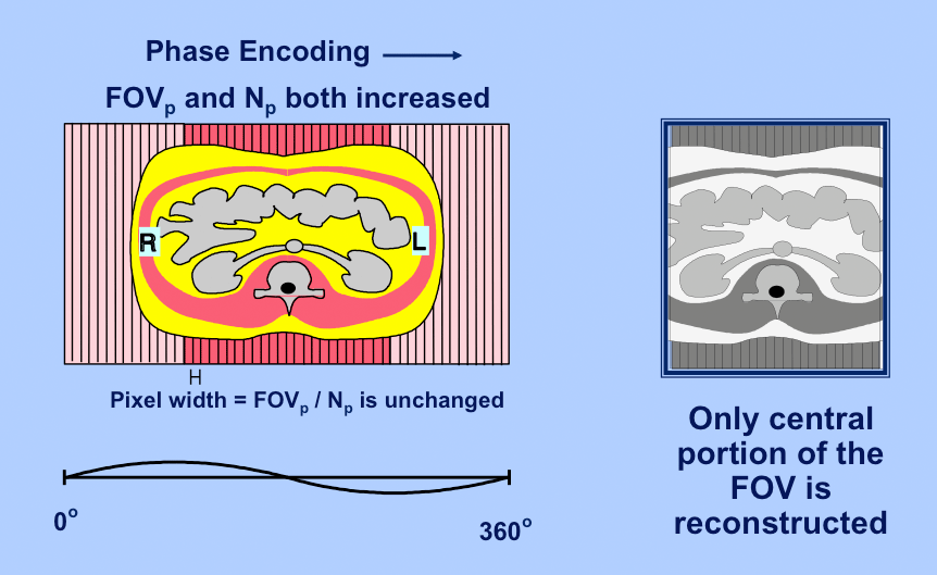 mri之卷褶伪影_mri卷折伪影-CSDN博客
