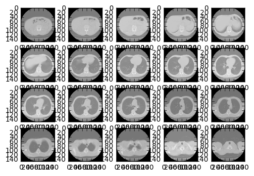 01_kaggle - Using a 3D Convolutional Neural Network on medical imaging ...