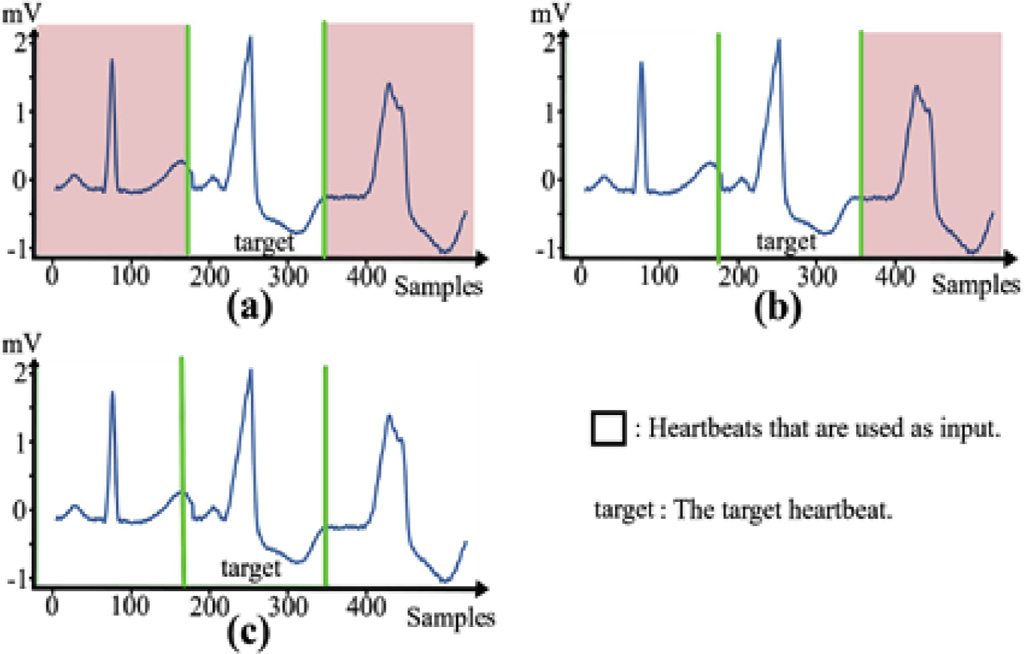 基于深度学习的ECG论文笔记(一)_基于深度学习的心律失常判别英文论文-CSDN博客