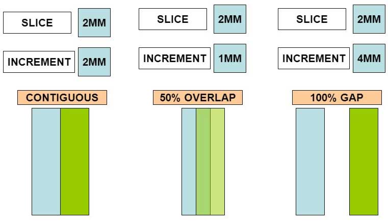 slice thickness 和 slice increment-CSDN博客
