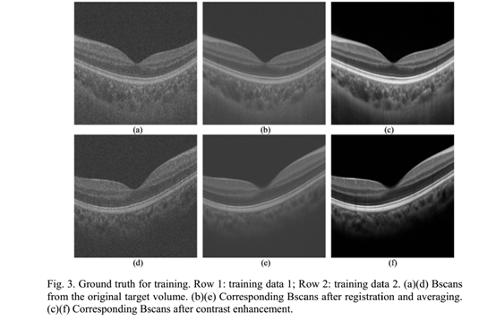《Speckle noise reduction in optical coherence tomography images based ...