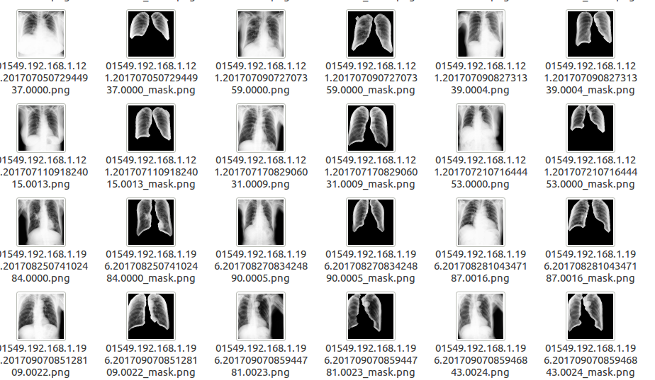 医疗影像深度学习－ChexNet肺结核(DR_AI)-CSDN博客