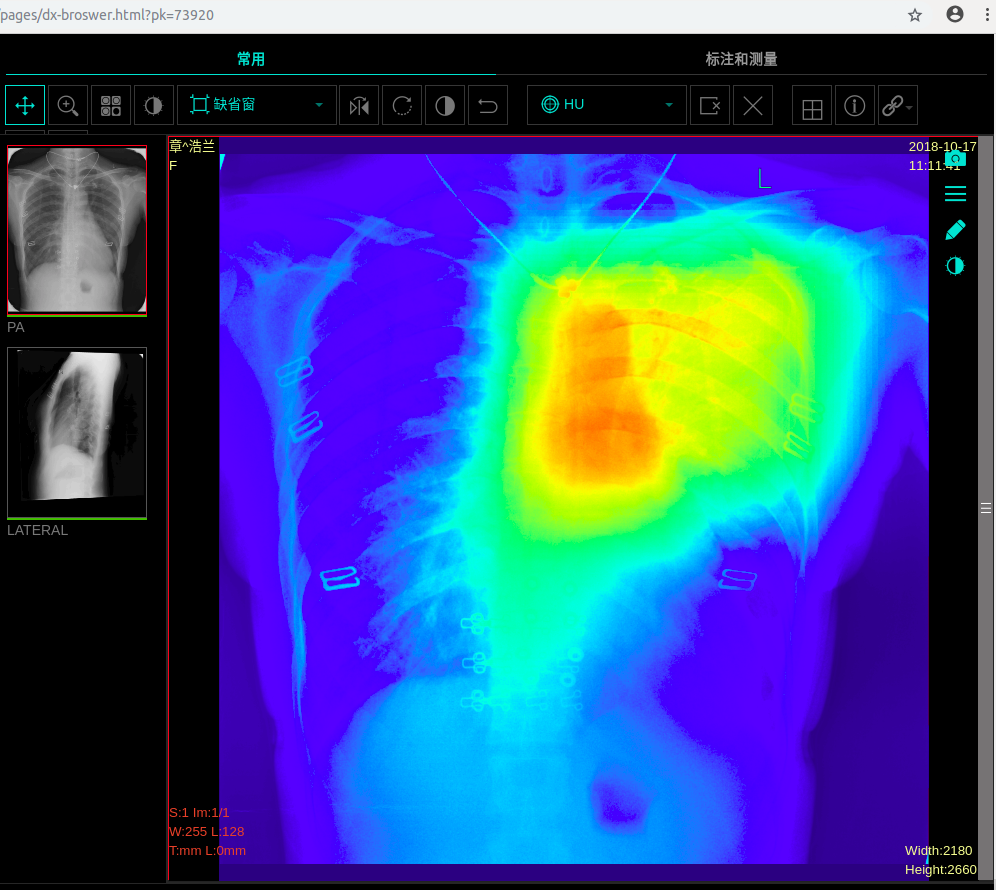 医疗影像深度学习－ChexNet肺结核(DR_AI)-CSDN博客