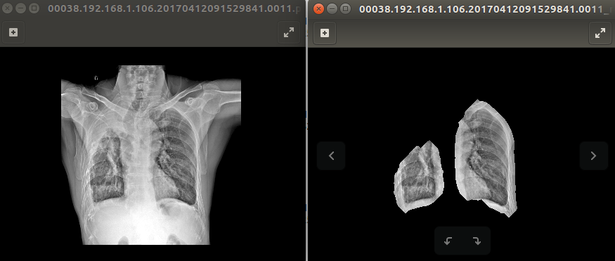 医疗影像深度学习－ChexNet肺结核(DR_AI)-CSDN博客