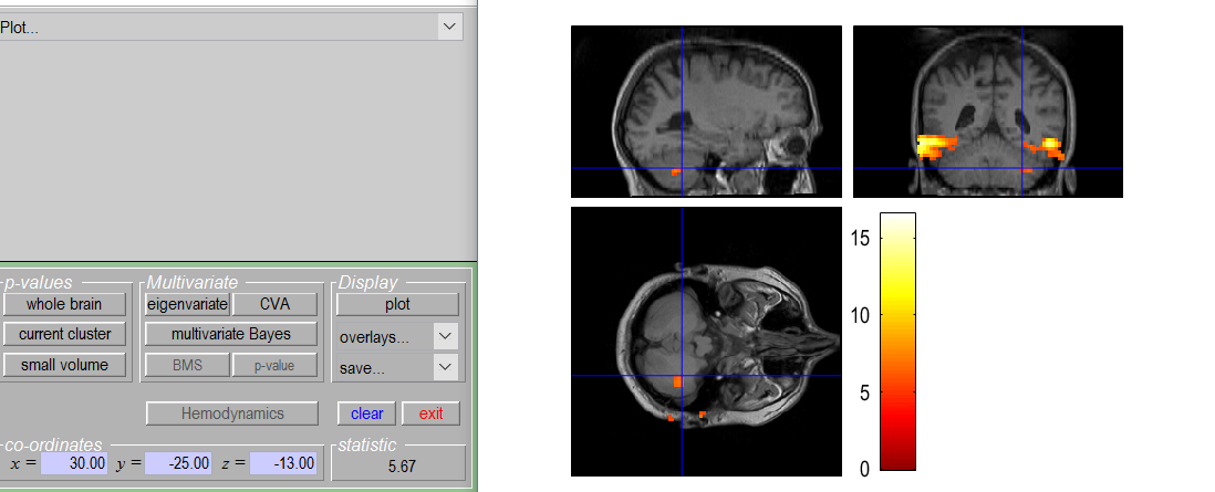 SPM12入门案例1_matlab的spm中check reg-CSDN博客