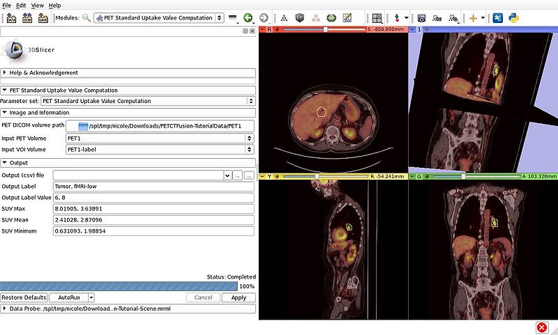 3Dslicer中 PET/CT 模块：PET Standard Uptake Value Computation_petstandarduptakevaluecomputation-CSDN博客