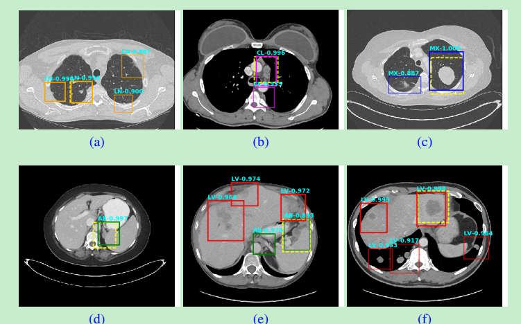 DeepLesion: Automated Deep Mining, Categorization and Detection of Significant ...