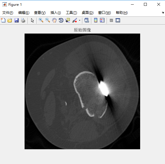 CT图像去除金属伪影-MATLAB实现_ct金属伪影 matlab-CSDN博客