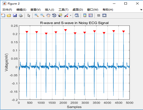 数字形态学-QRS波中的R波检测-CSDN博客