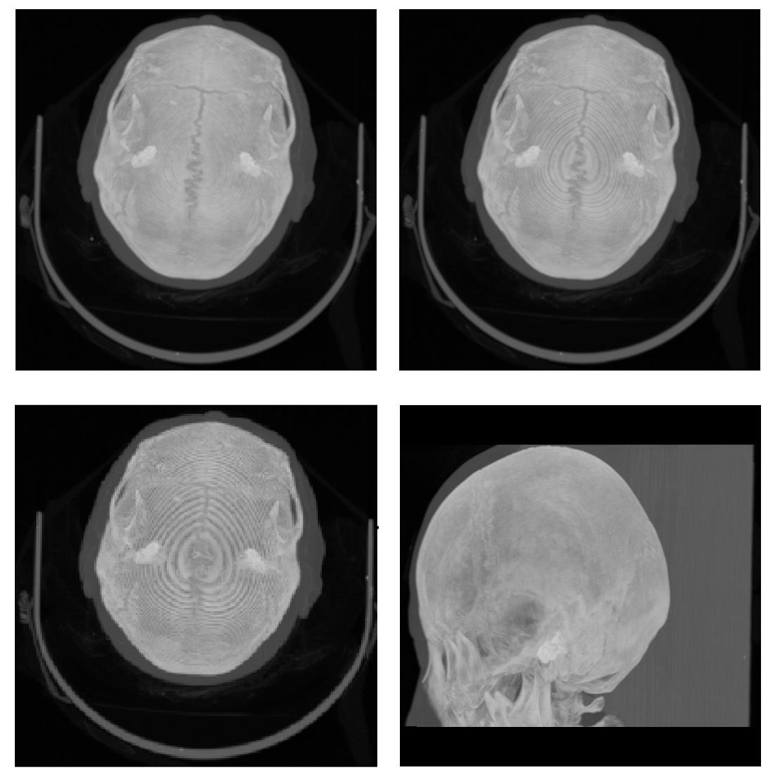 （医学三维重建）MATLAB体绘制算法：最大密度投影（MIP）-CSDN博客