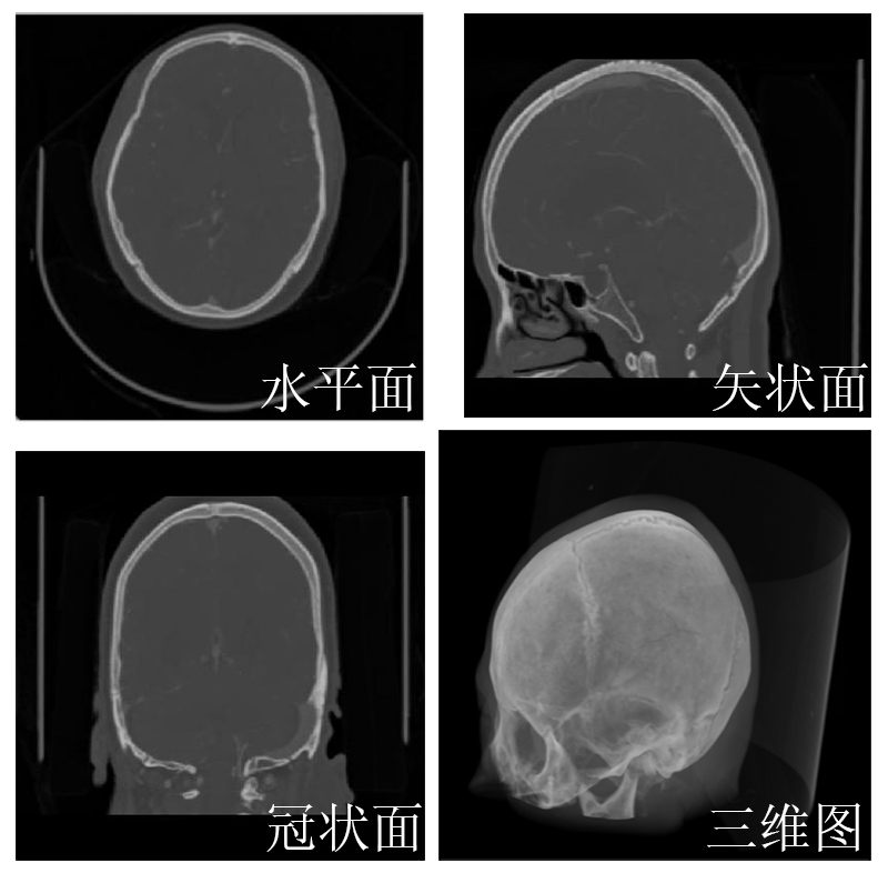 （医学三维重建）MATLAB体绘制算法：多层面重建（MPR）_mri重建matlab代码-CSDN博客