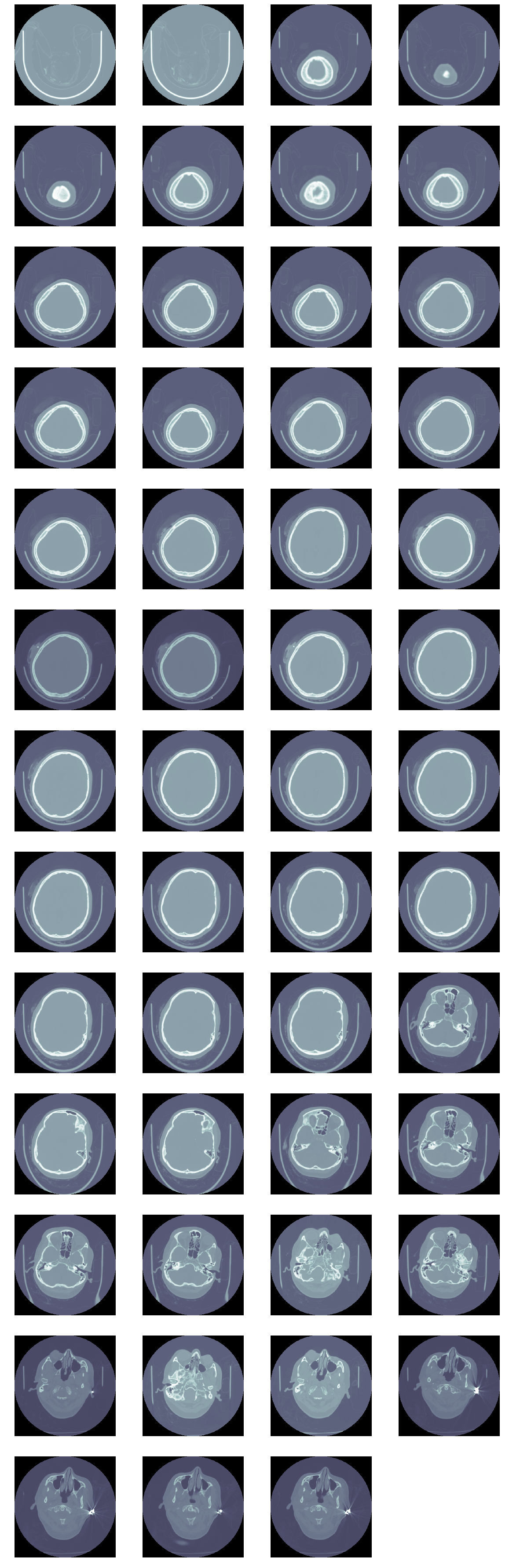 头部 CT 图像三维重建_3d 脑ct 数据集-CSDN博客