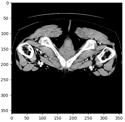 CT图像预处理之window transform_newimg = (newimg * 255).astype('uint8')-CSDN博客
