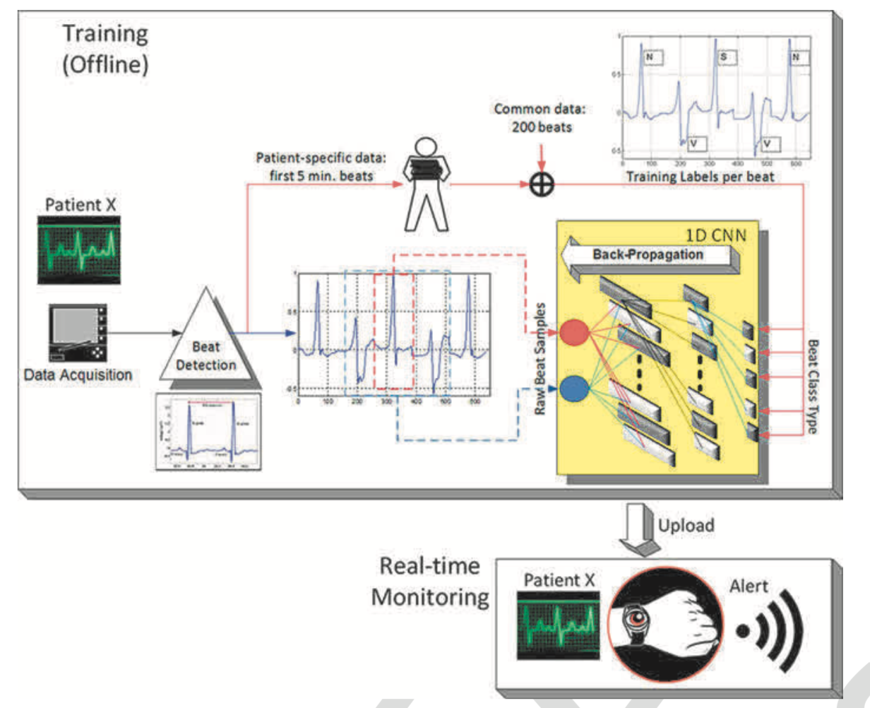 论文笔记：Real-Time Patient-Specific ECG Classification by 1-D Convolutional ...