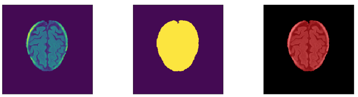 【医疗影像处理】Erosion and Dilation of medical images masks using scipy.ndimage in python_对医学3d分割图像进行腐蚀 ...