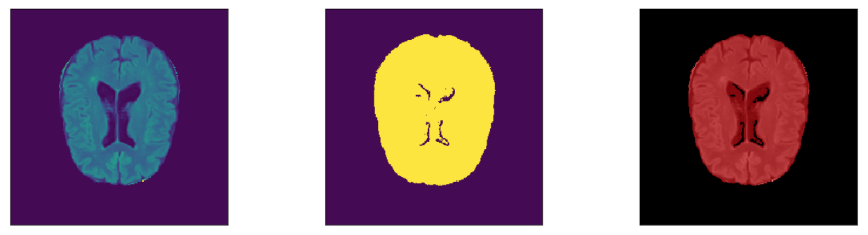 【医疗影像处理】Erosion and Dilation of medical images masks using scipy ...