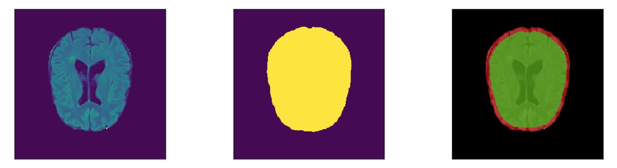 【医疗影像处理】Erosion and Dilation of medical images masks using scipy.ndimage in python_对医学3d分割图像进行腐蚀 ...