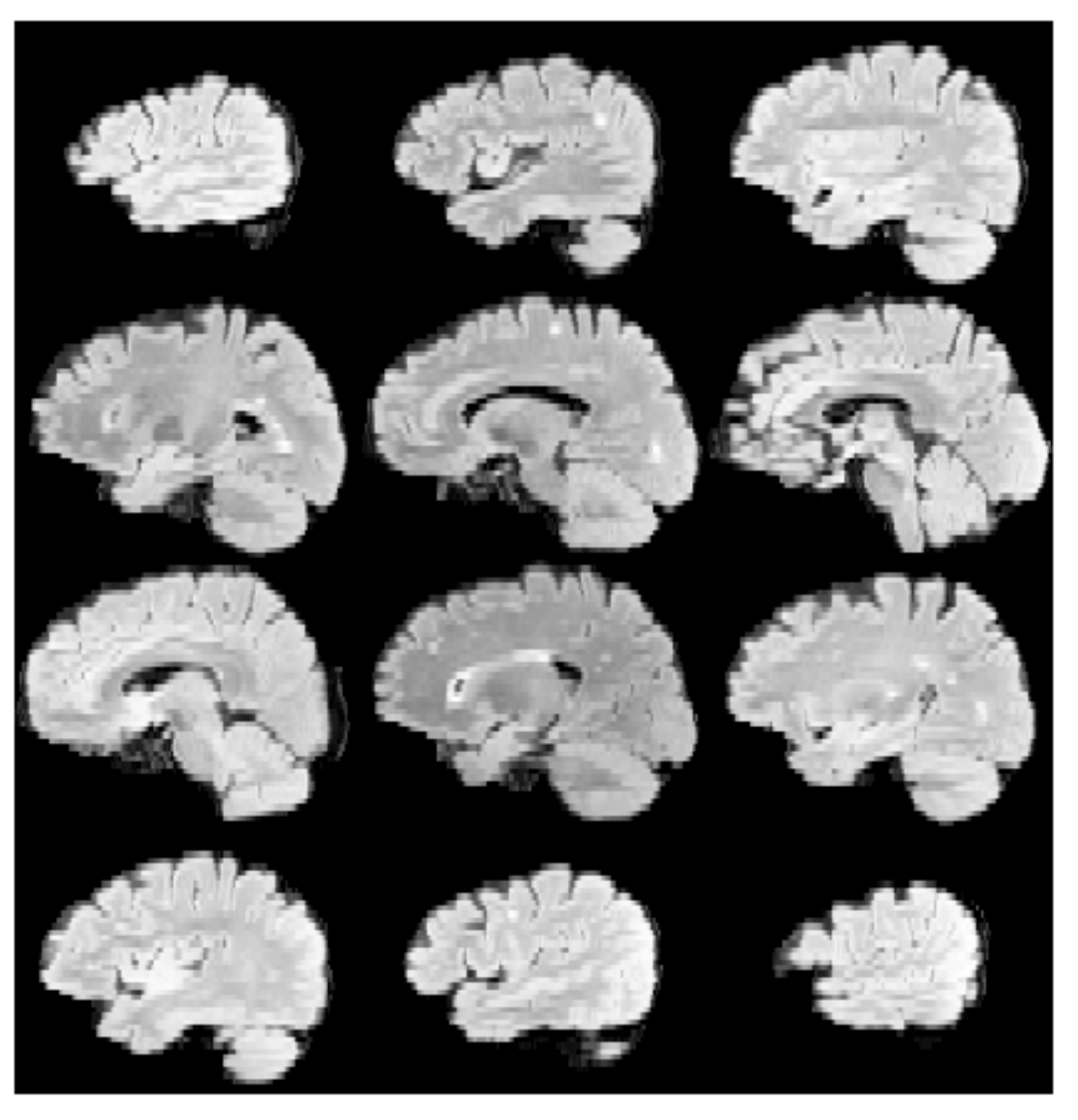 【医疗影像处理】脑部MRI影像denoise方法总结[antspy]_脑部mri图像处理-CSDN博客