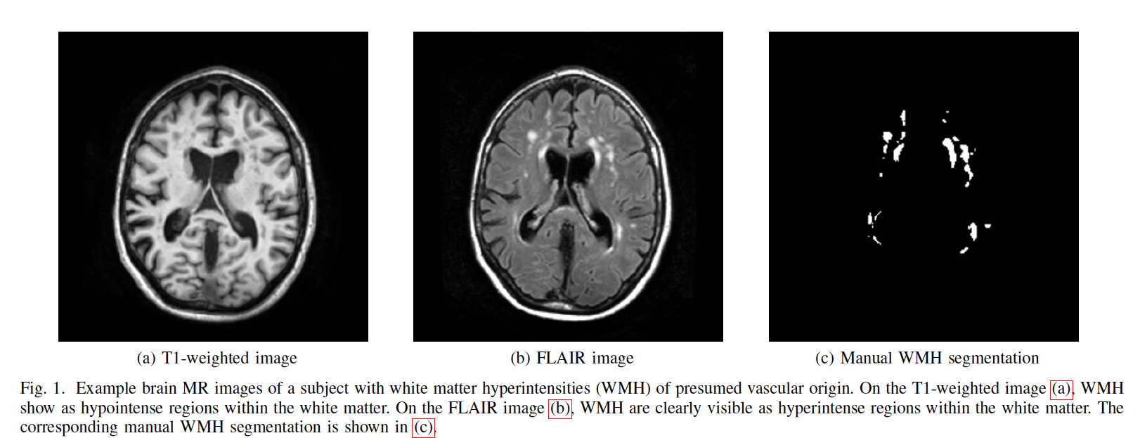 【论文阅读】WMH Segmentation Challenge 2017 及第一名解决方案_wmh白质高信号体积计算工具-CSDN博客