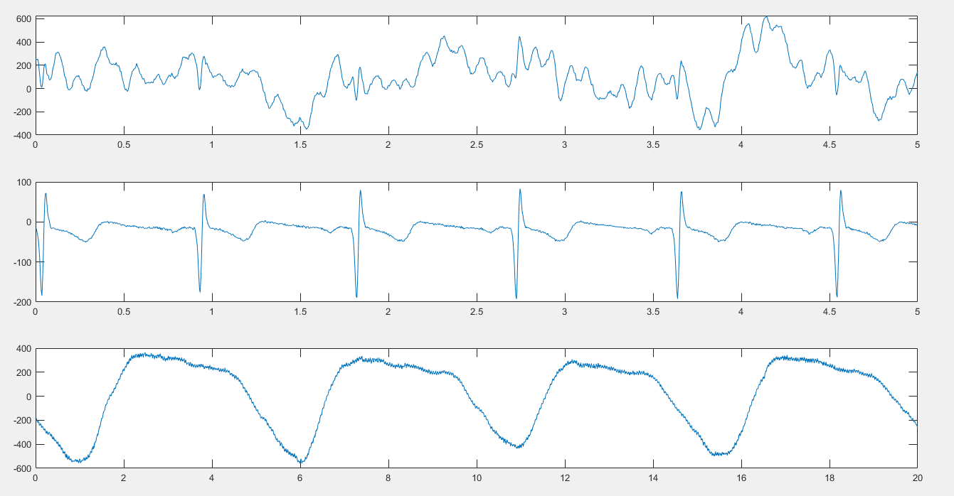 MIT-BIH数据库PSG信号提取（含EEG）_mit数据库信号正常-CSDN博客