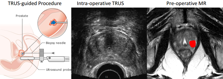 learn2reg-监督、弱监督和监督图像配准_target registration error-CSDN博客