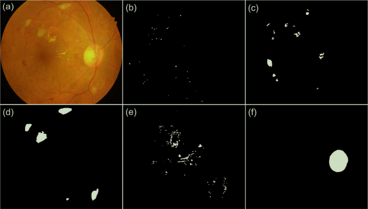【眼底数据集】RETOUCH & REFUGE & IDRiD_refuge数据集-CSDN博客