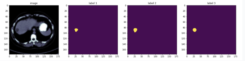 【SimpleITK】分割结果融合策略_分割结果重合-CSDN博客
