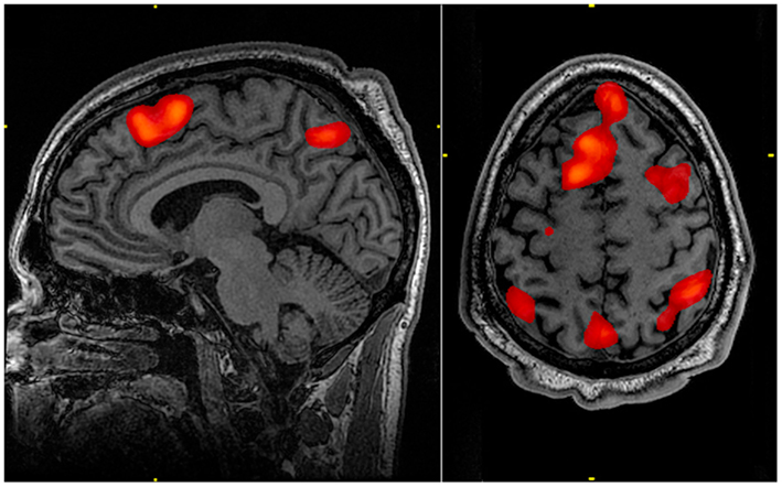 EEG vs MRI vs fMRI vs fNIRS简介_fmri meg fnirs eeg 对优势分别是什么-CSDN博客