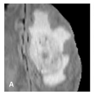 [概念]MICCAI+BraTS+多模态t1,t2,flair,t1c+HGG,LGG+WT,ET,TC_et wt tc的指标计算代码-CSDN博客