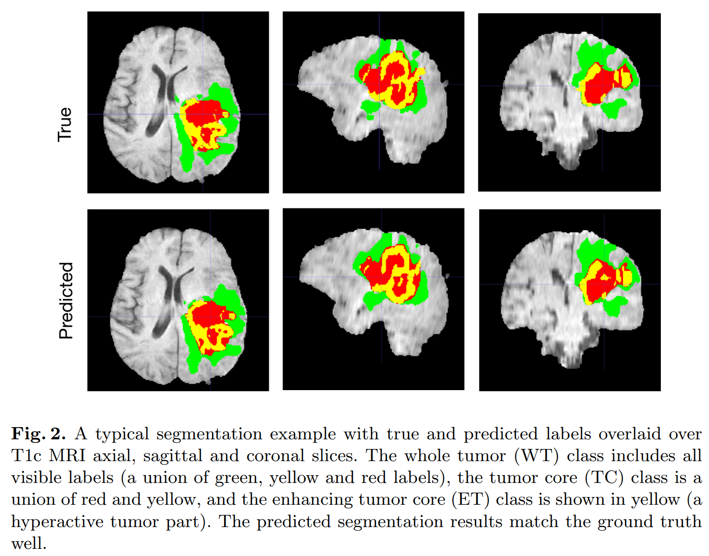 [论文翻译]Brats18 NO.1:3D MRI brain tumor segmentation using autoencoder regularization_brats2018在线 ...