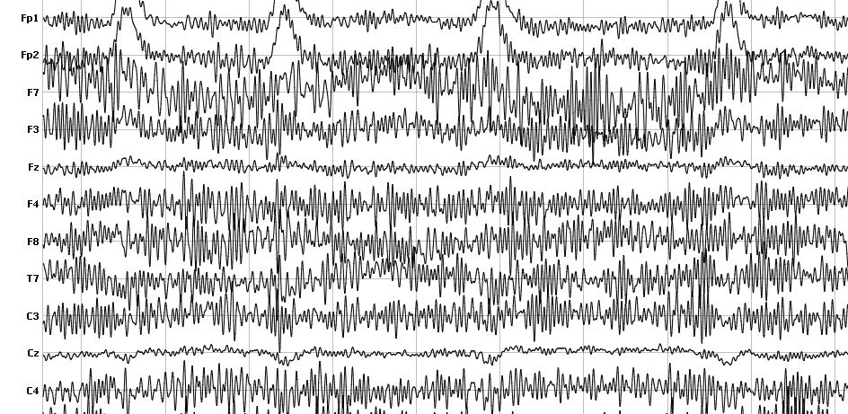 动态脑电图(Ambulatory EEG)及其工作过程、数据处理_动态脑电图位置-CSDN博客