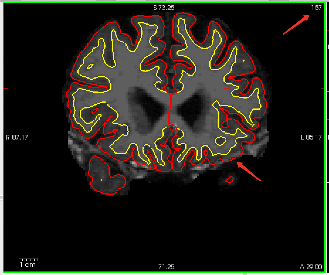 Freesurfer学习笔记——Correcting Pial Surfaces 3.1