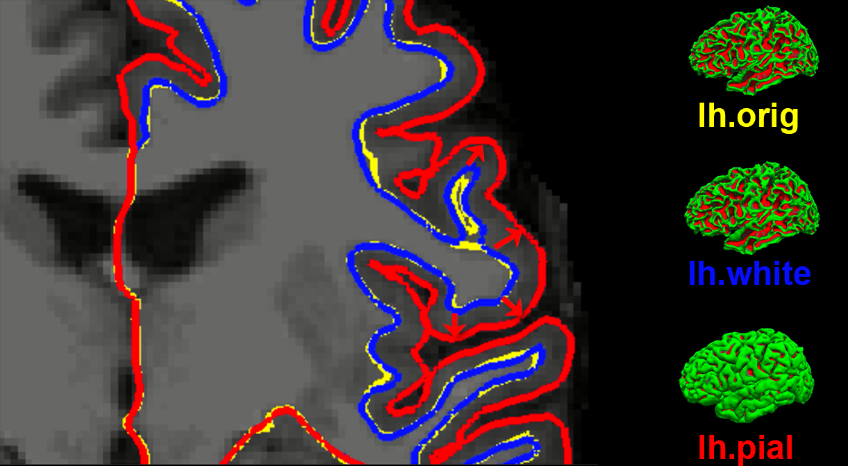 Recon-all命令实例_recon-all的所有程序-CSDN博客