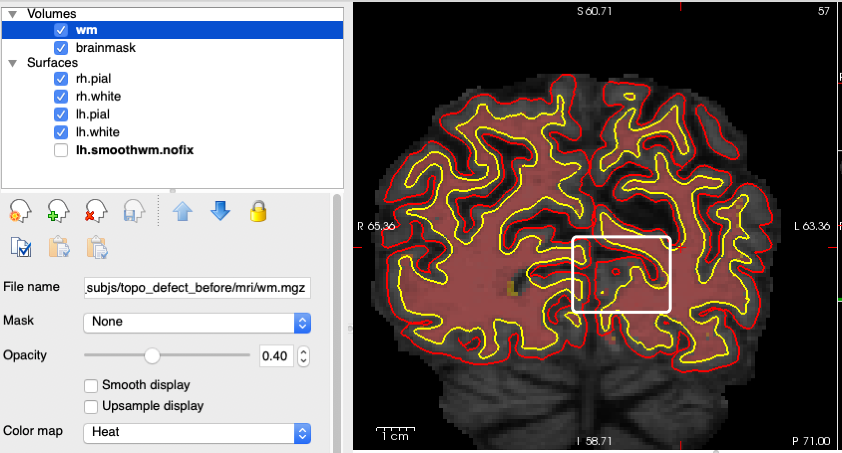 Freesurfer学习笔记——Correcting topological defects (white surface error)3.3_用freeview检查数据质量-CSDN博客