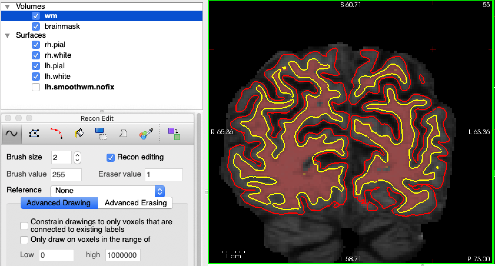 Freesurfer学习笔记——Correcting topological defects (white surface error)3.3_用freeview检查数据质量-CSDN博客