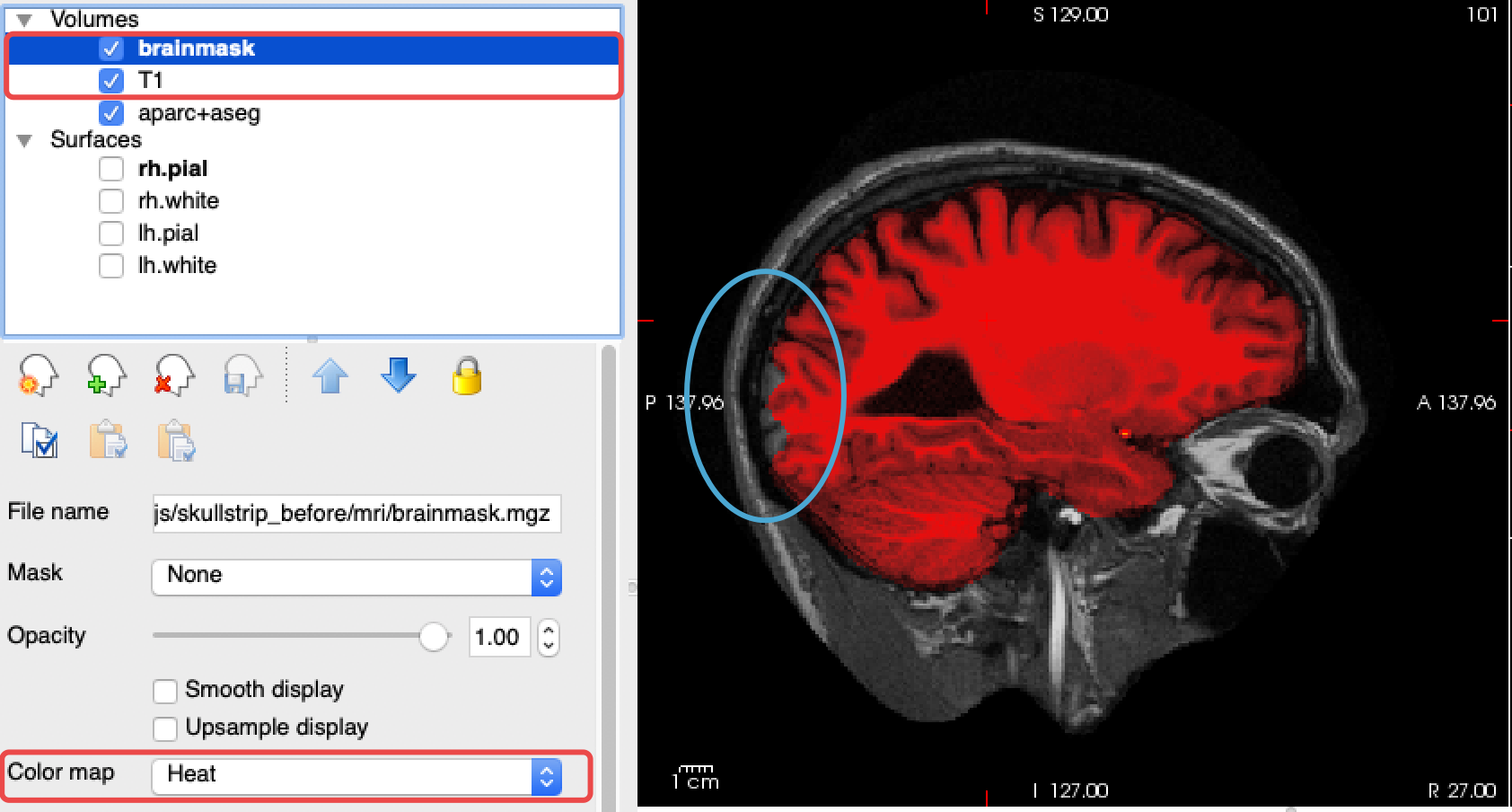 Freesurfer学习笔记——Fixing a bad skull strip3.4_freesurfer怎么看颅骨有没有剥干净-CSDN博客