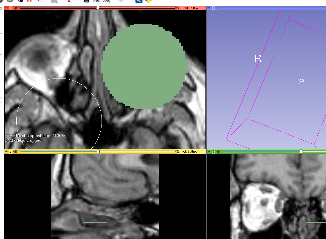 超级简单的3D slicer教程（三）creating label Map_3d slicer roi删除-CSDN博客